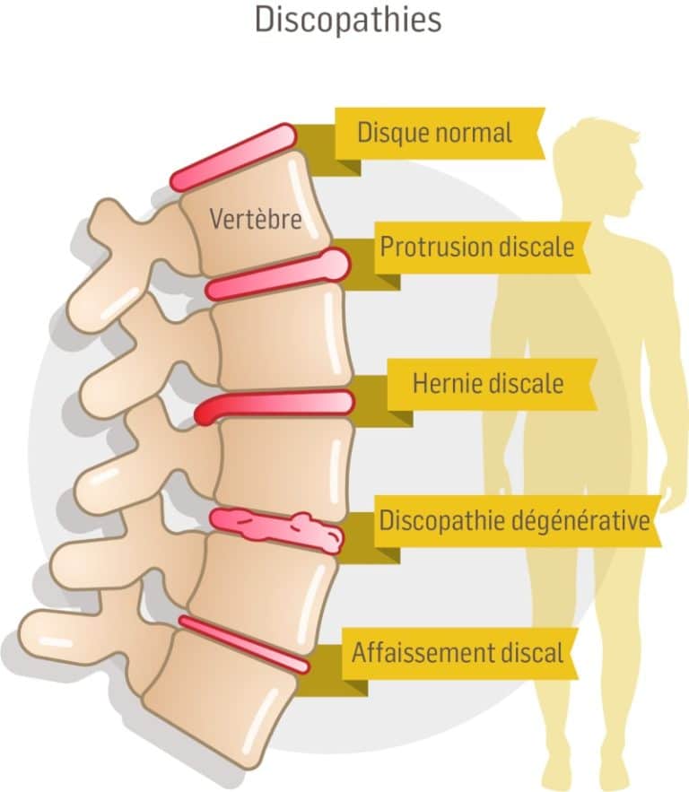 Maux de dos dus à la sédentarité : causes et conseils - Dorsoo