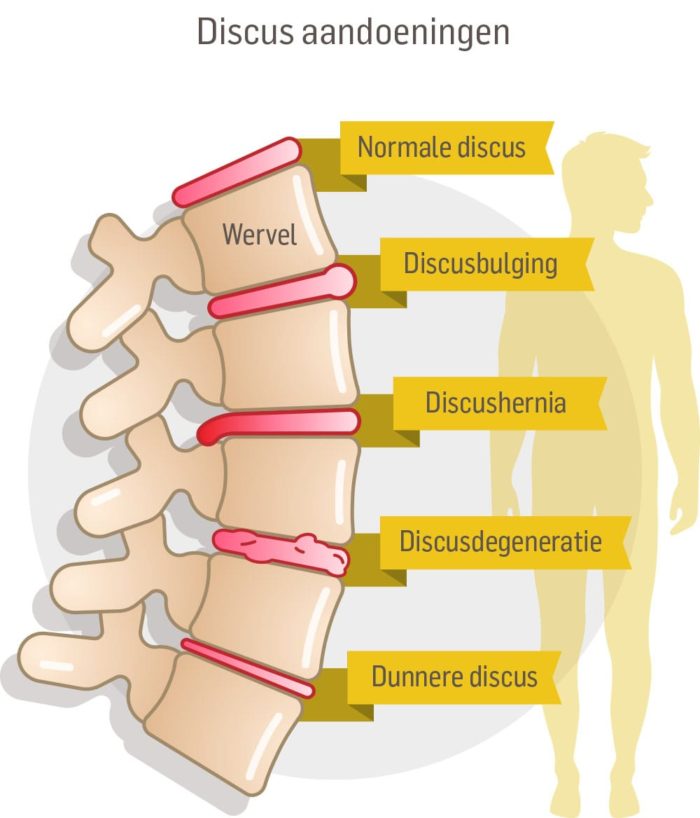Rugpijn door zittend werk: oorzaken en tips - Dorsoo